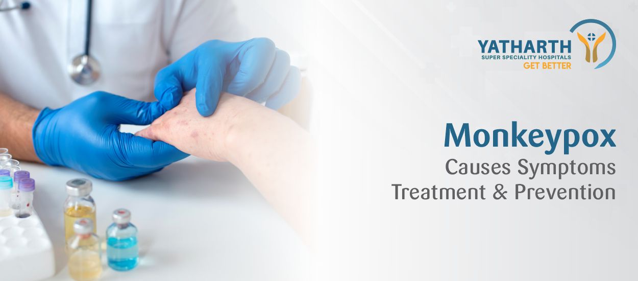 Monkeypox Causes Symptoms Treatment and Prevention - Yatharth Hospitals